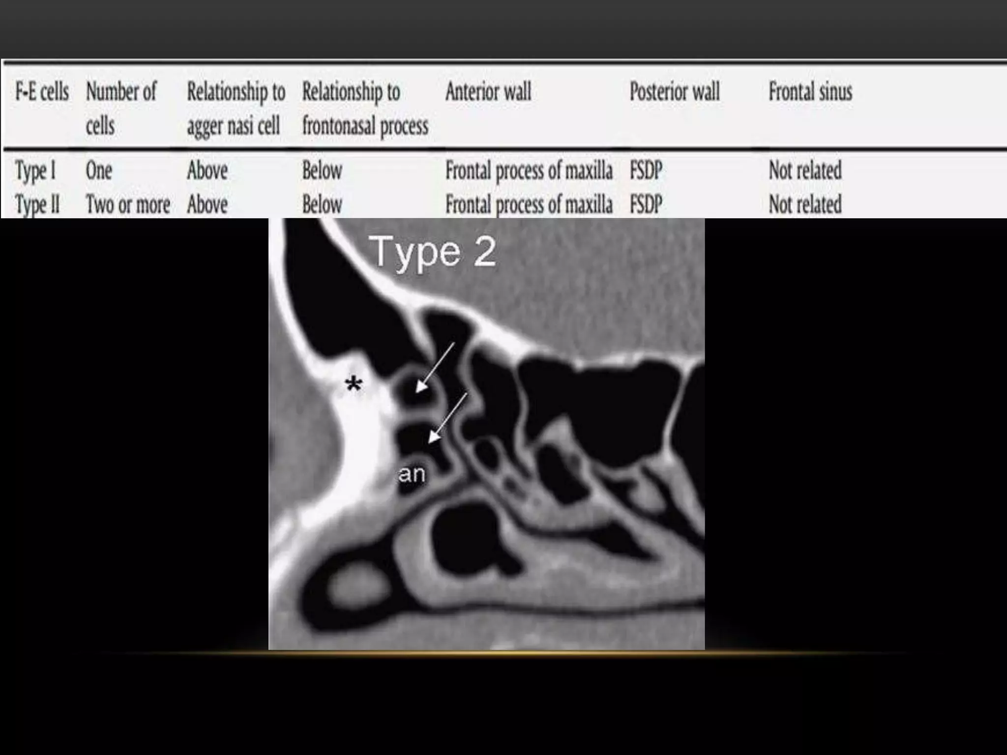 Pre-FESS PNS CT | PPT