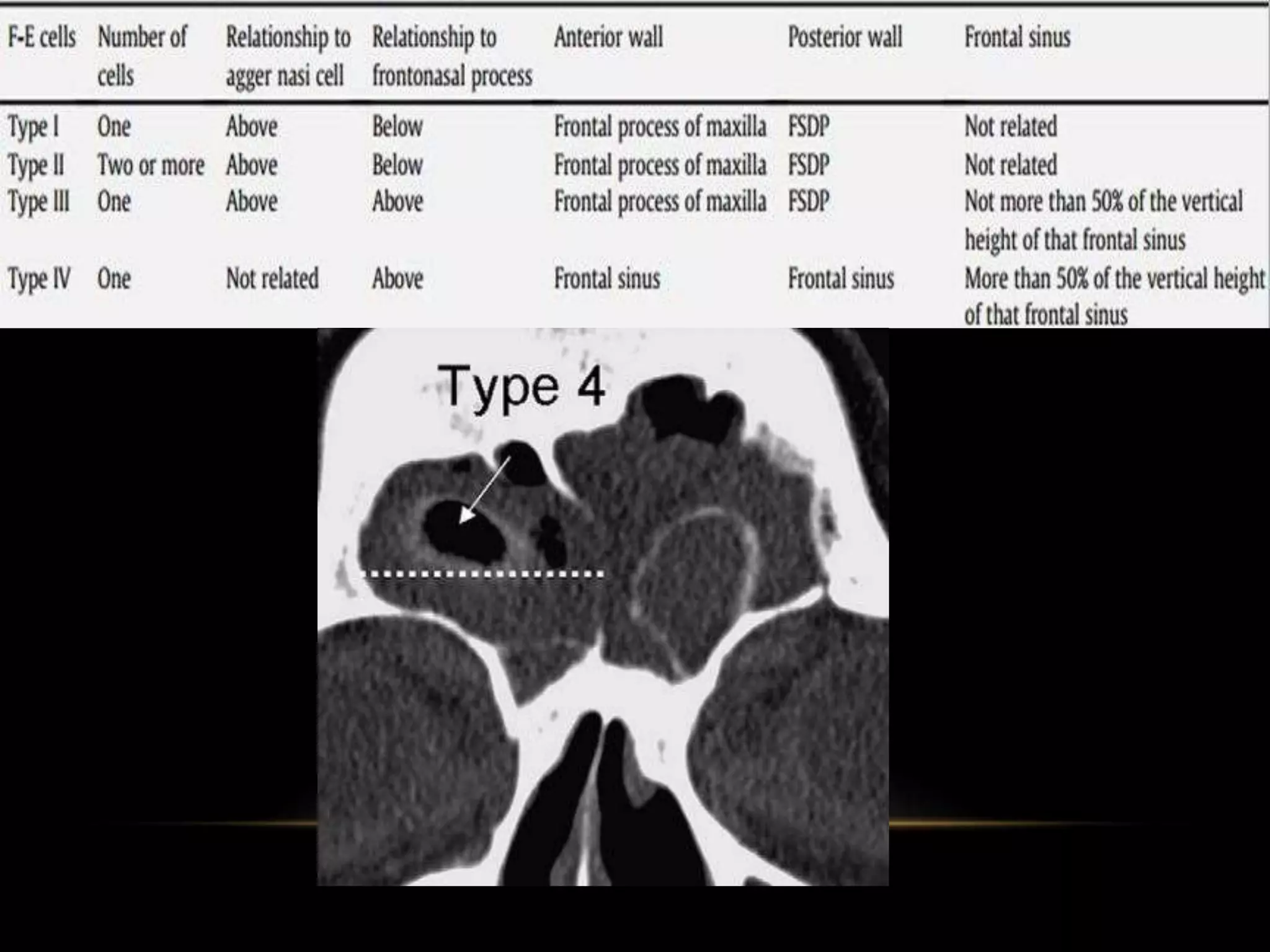 Pre-FESS PNS CT | PPT