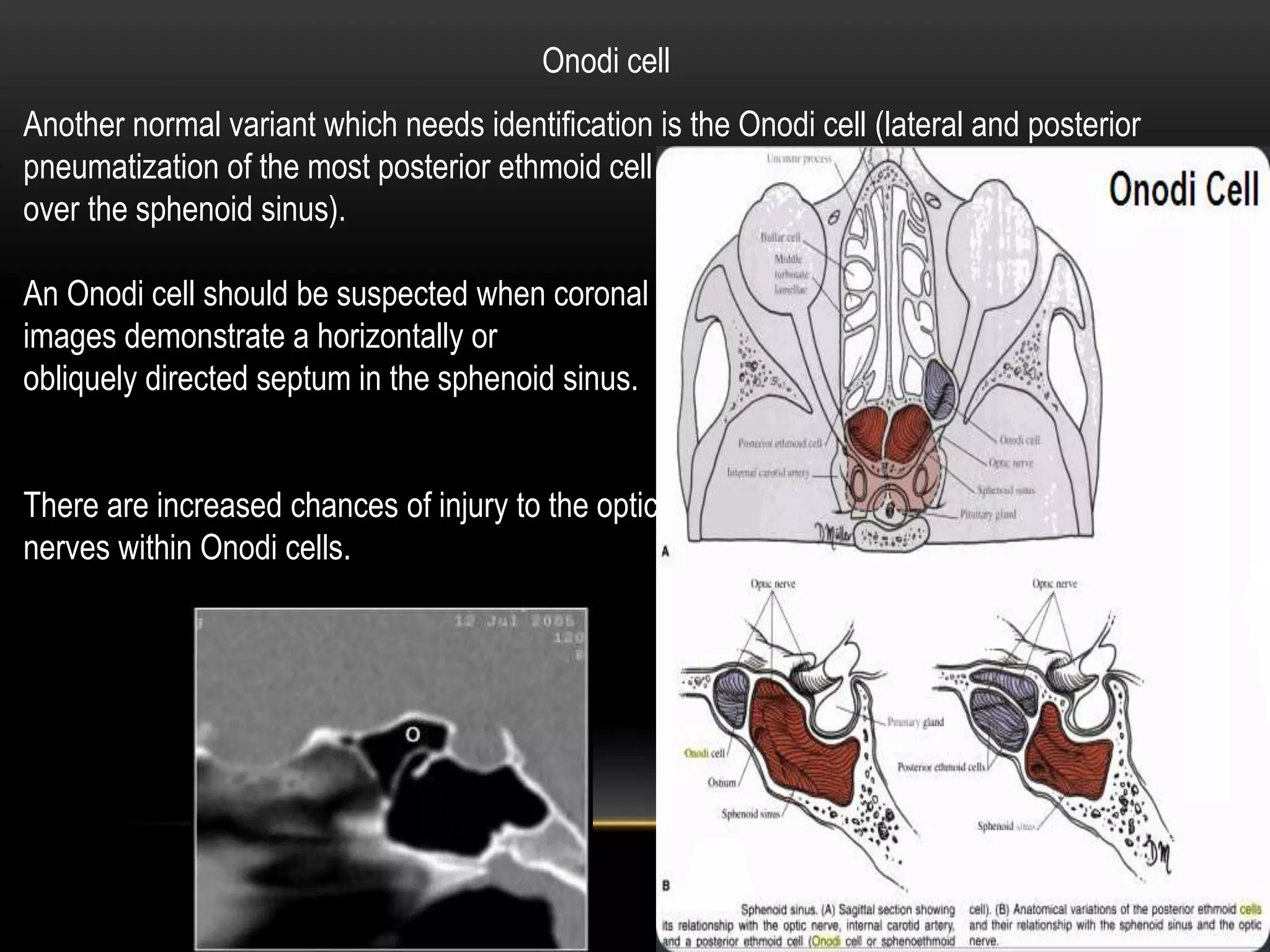 Pre-FESS PNS CT | PPT