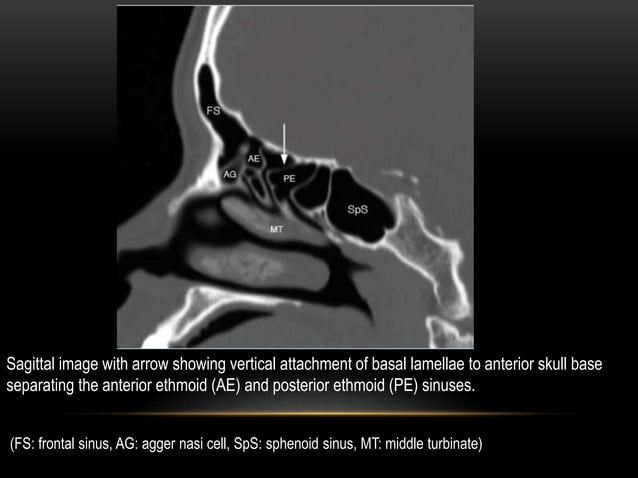 Pre-FESS PNS CT | PPT