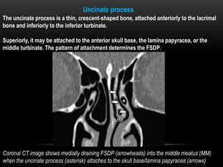Pre-FESS PNS CT | PPT