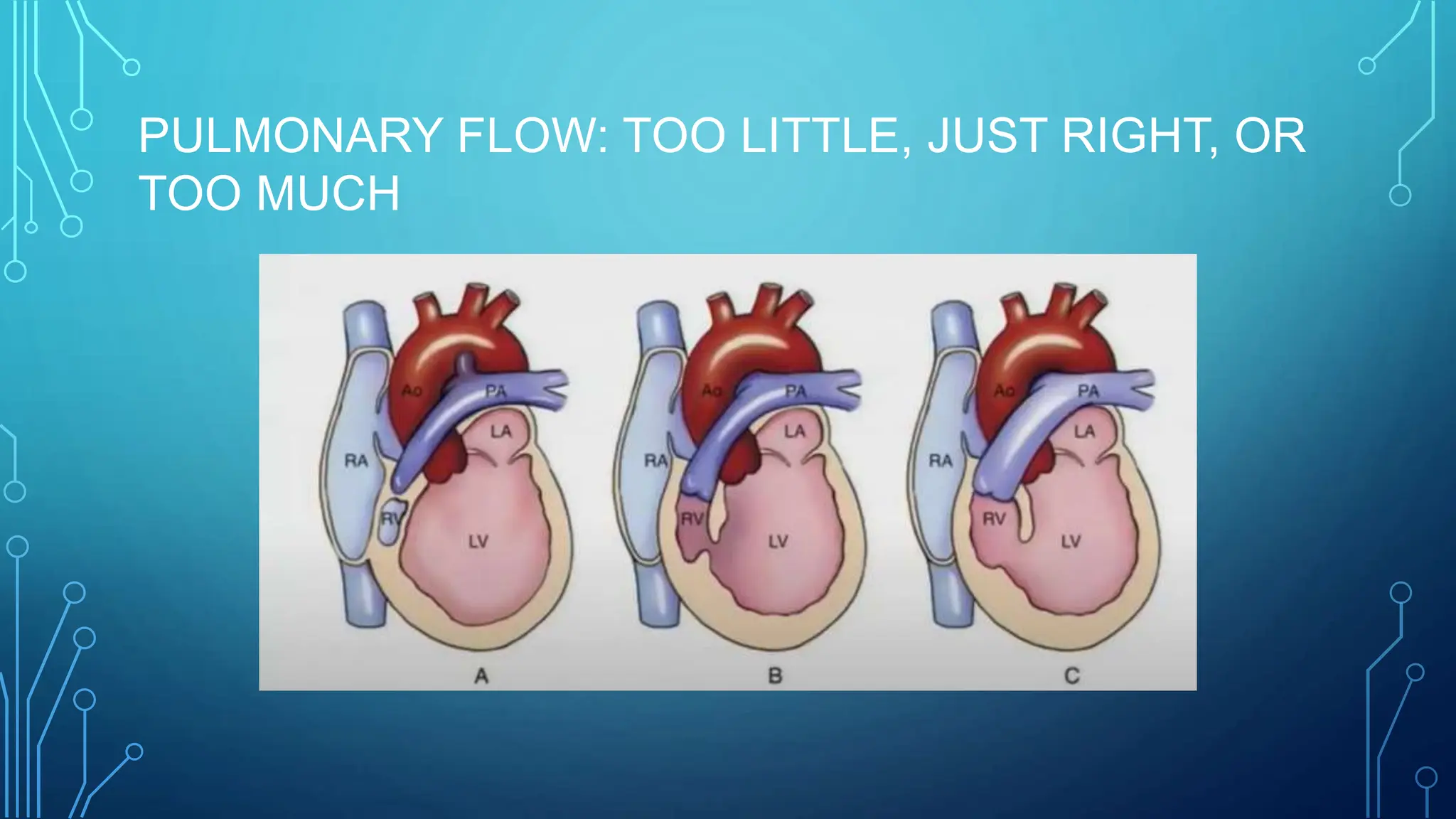 Pre Fontan Palliation Surgery in Single Ventricle Congenital Heart Disease.pptx