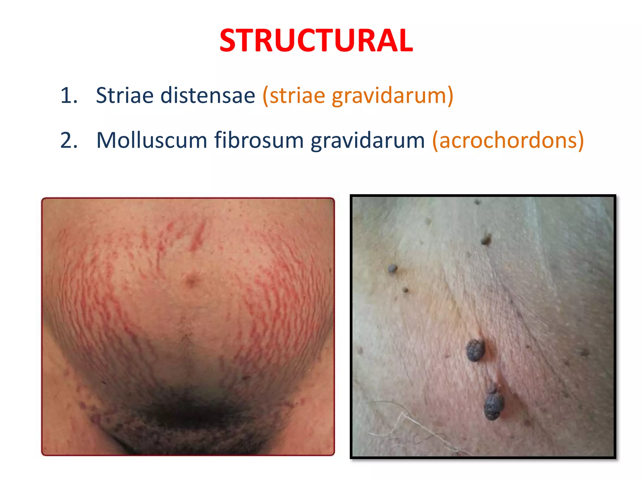 Pregnancy Dermatoses | PPTX