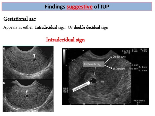 Pregnancy of unknown location