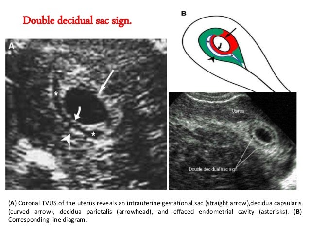 Pregnancy of unknown location