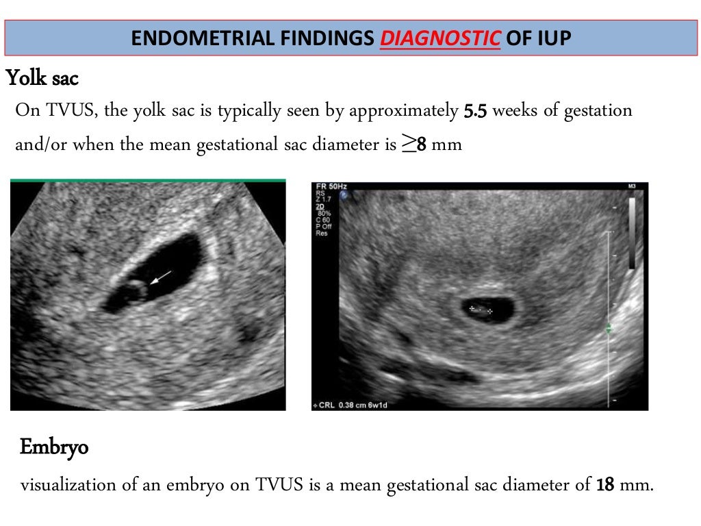 Pregnancy Of Unknown Location