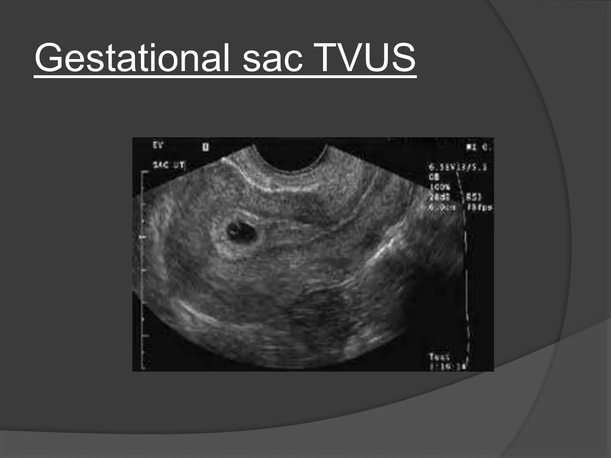 Pregnancy of unkown location | PPTX