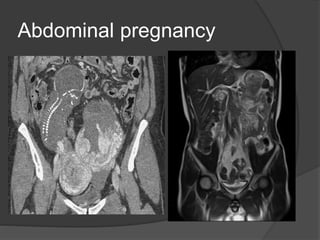 Pregnancy of unkown location | PPTX