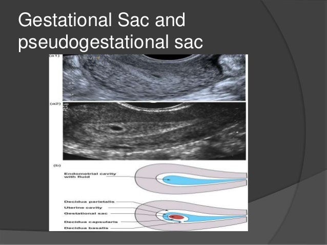 Pregnancy of unkown location