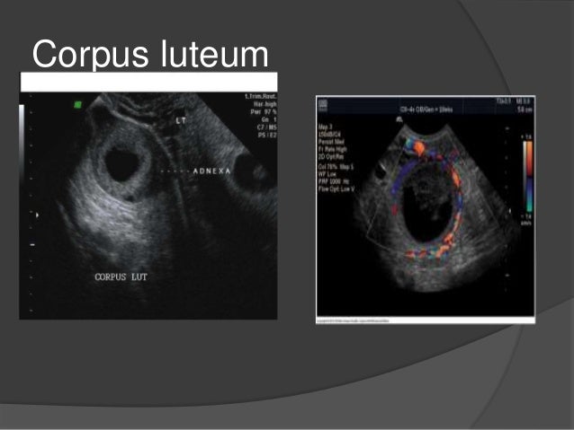 Corpus Luteum Cyst During Pregnancy