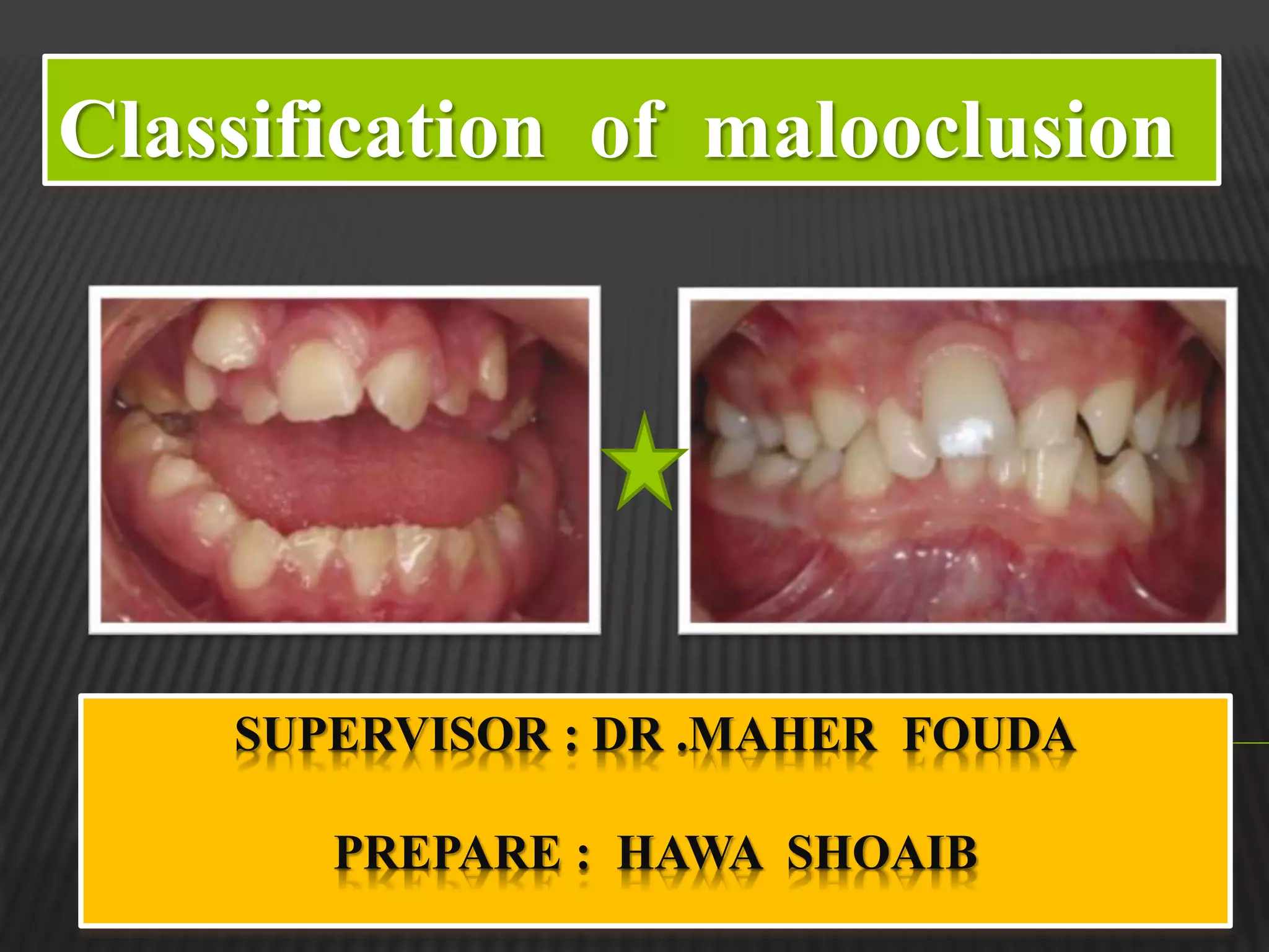 Classification of malooclusion | PPTX