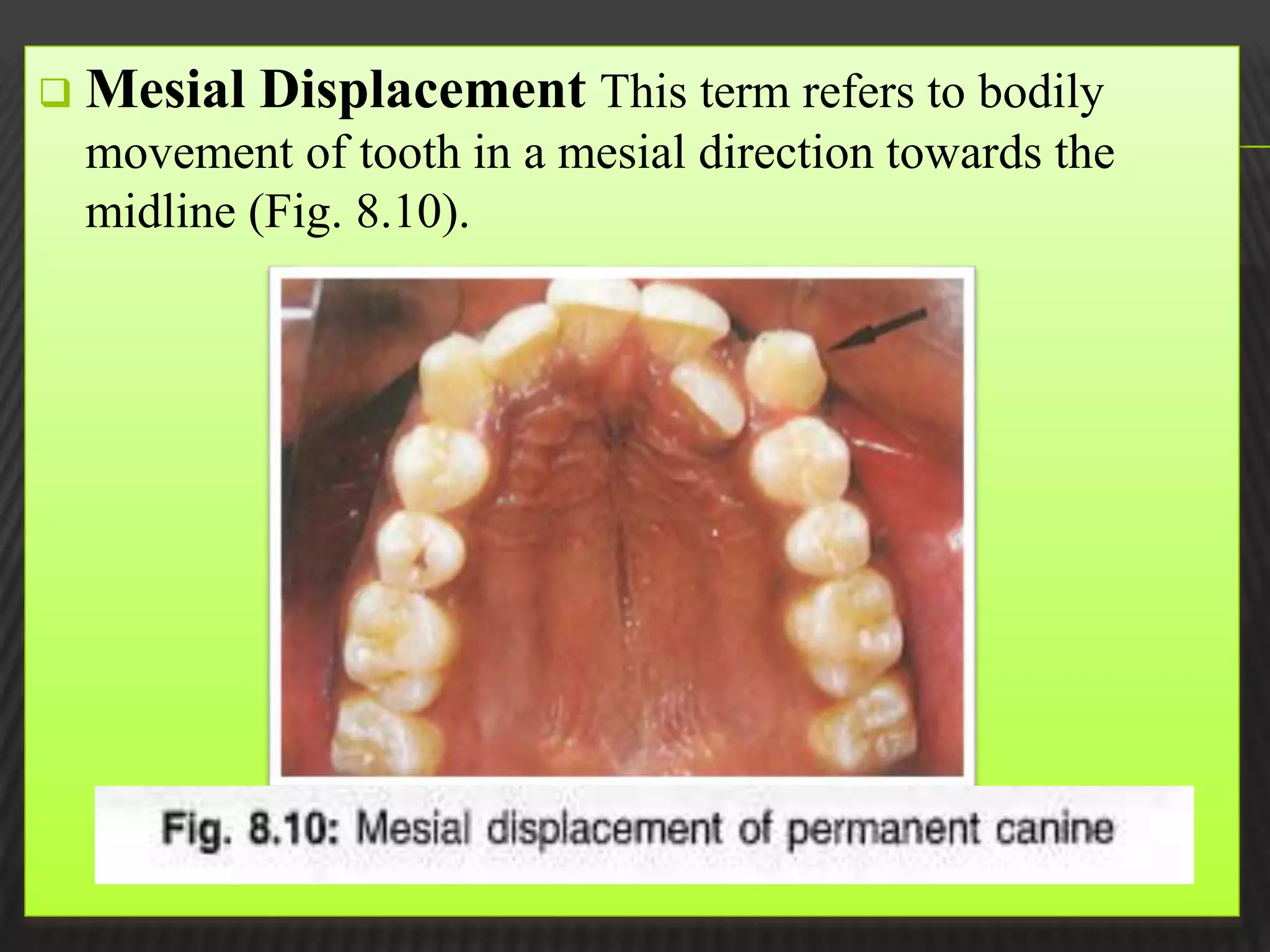 Classification of malooclusion | PPTX