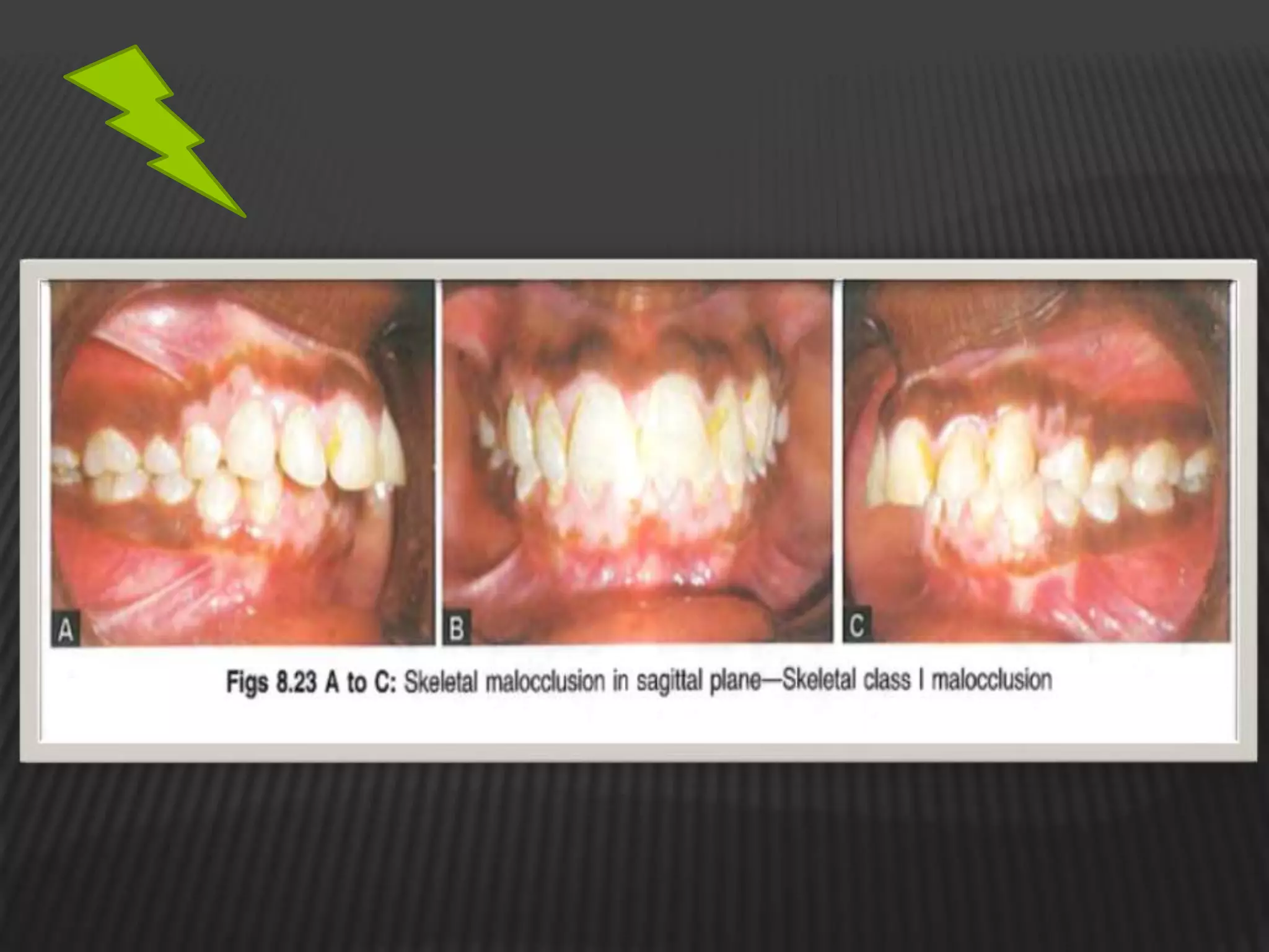 Classification of malooclusion | PPTX
