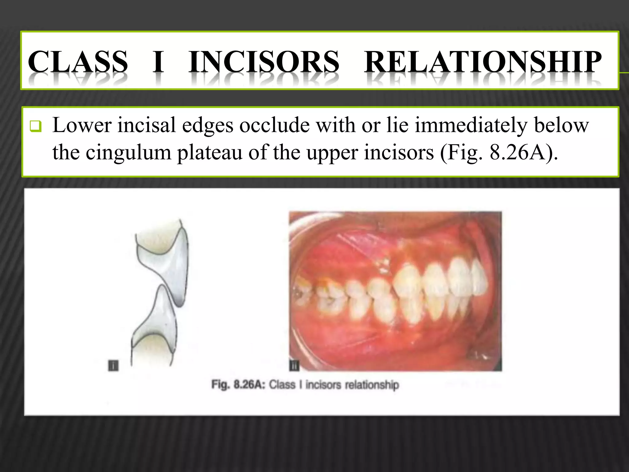 Classification of malooclusion | PPTX