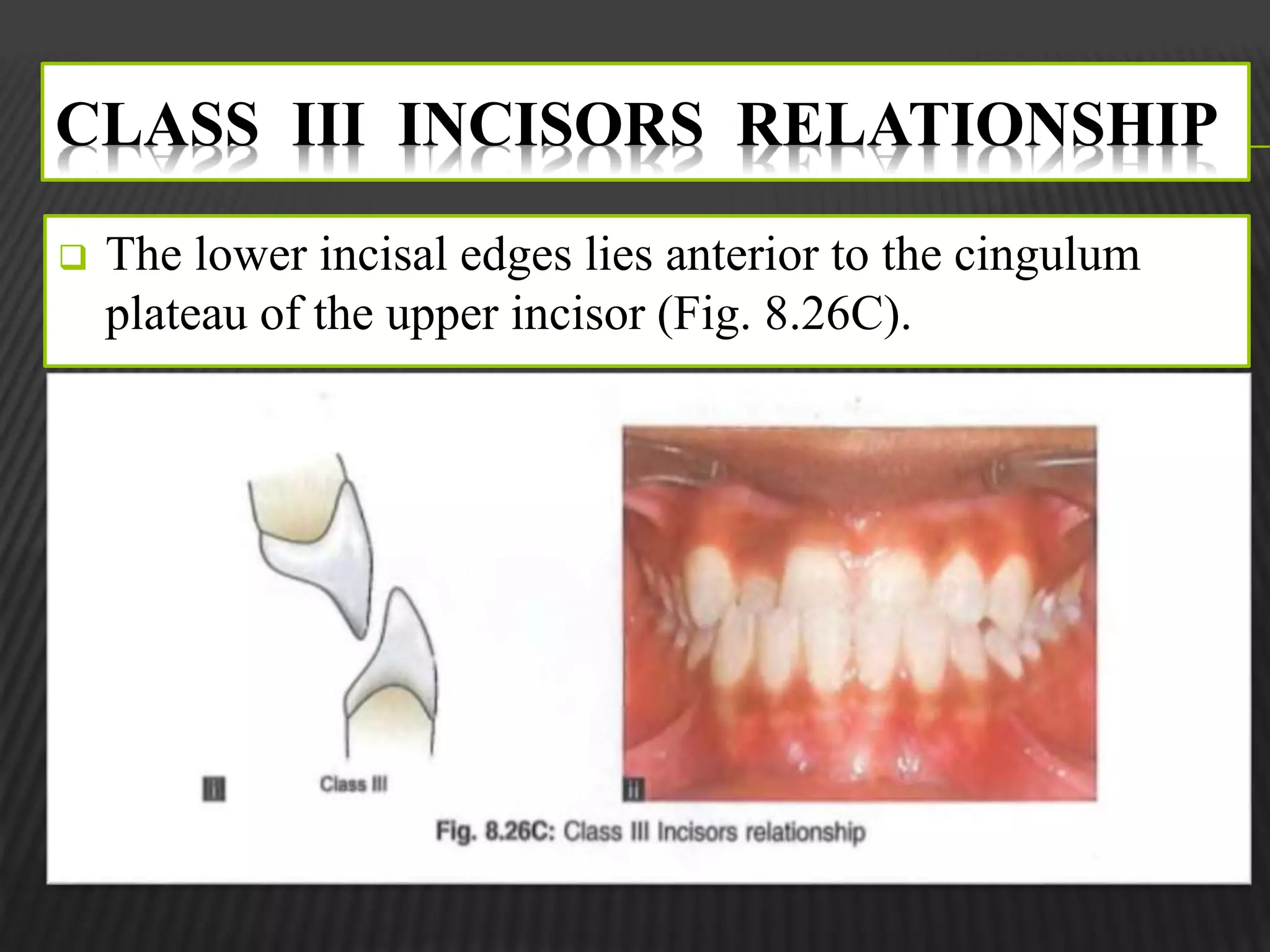 Classification of malooclusion | PPTX