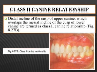 Classification of malooclusion | PPTX