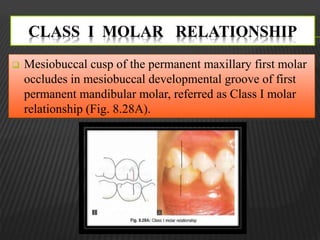 Classification of malooclusion | PPTX
