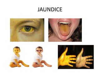 Pre hepatic jaundice | PPTX