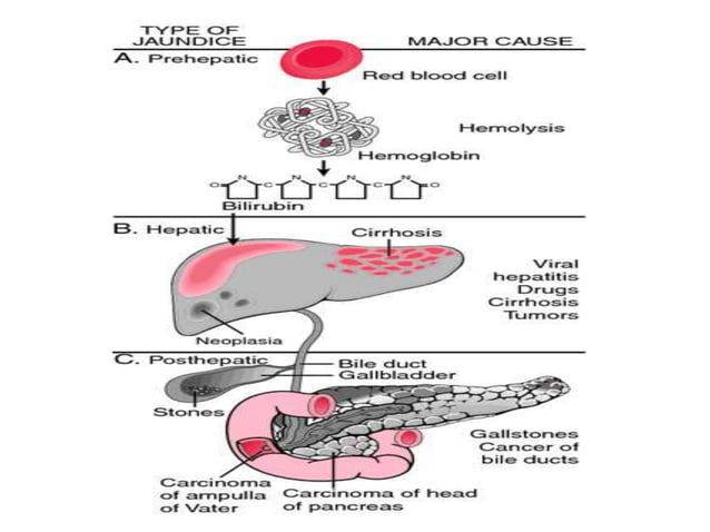 Pre hepatic jaundice | PPTX