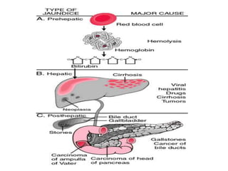 Pre hepatic jaundice | PPT