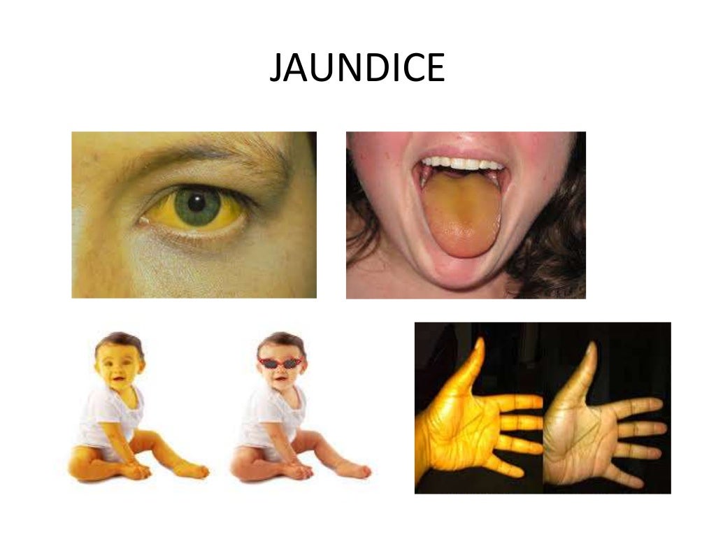 Pre hepatic jaundice