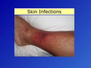 Prehospital Mrsa | PPT