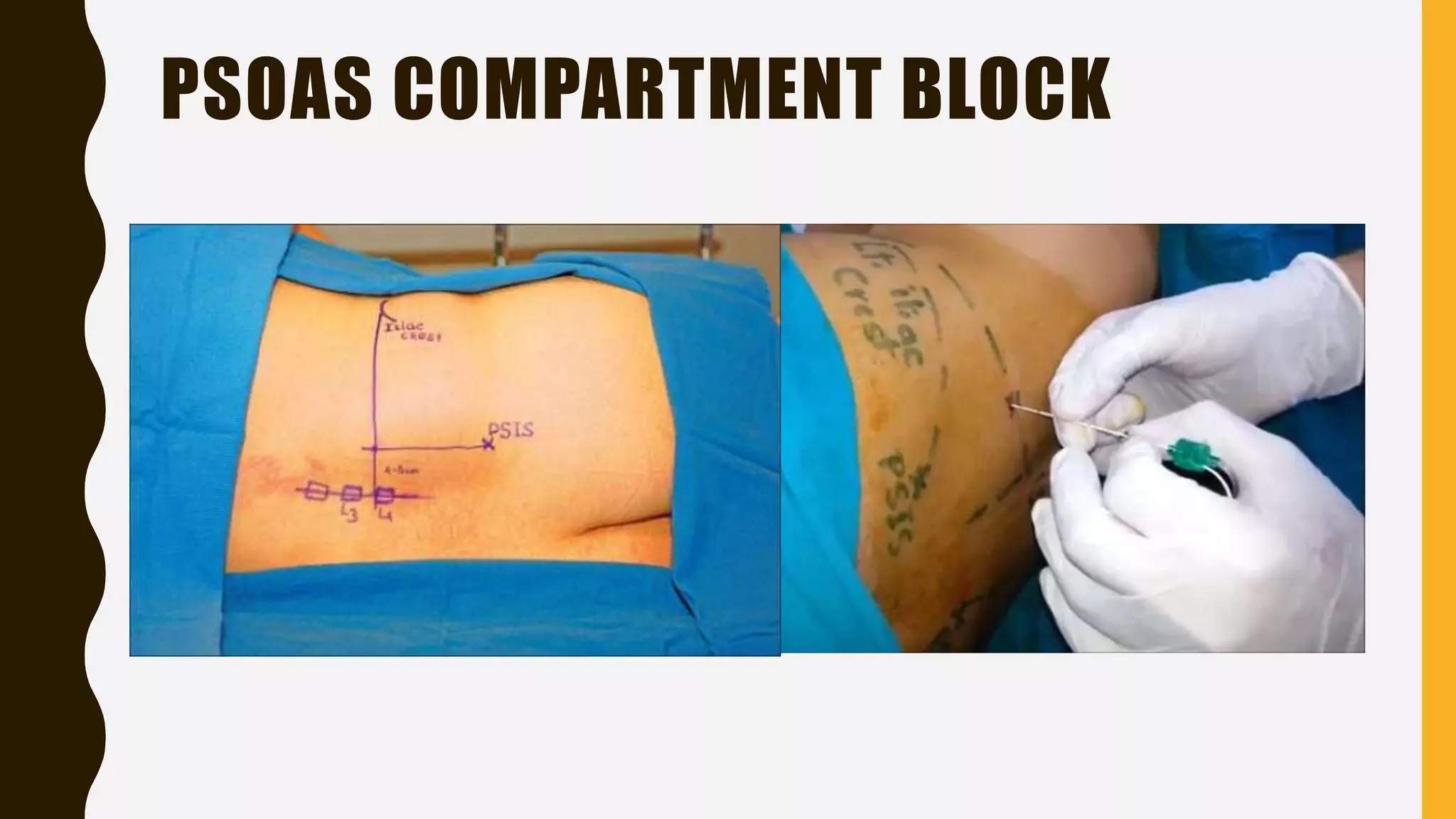 Prehospital thigh blocks | PPT