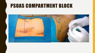 Prehospital thigh blocks | PPTX