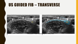 Prehospital thigh blocks | PPTX