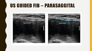 Prehospital thigh blocks | PPTX