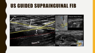 Prehospital thigh blocks | PPTX