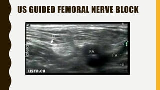 Prehospital thigh blocks | PPTX