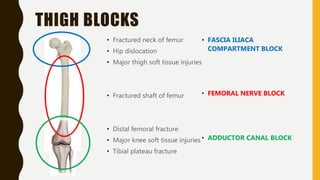 Prehospital thigh blocks | PPTX