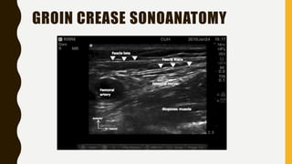 Prehospital thigh blocks | PPTX
