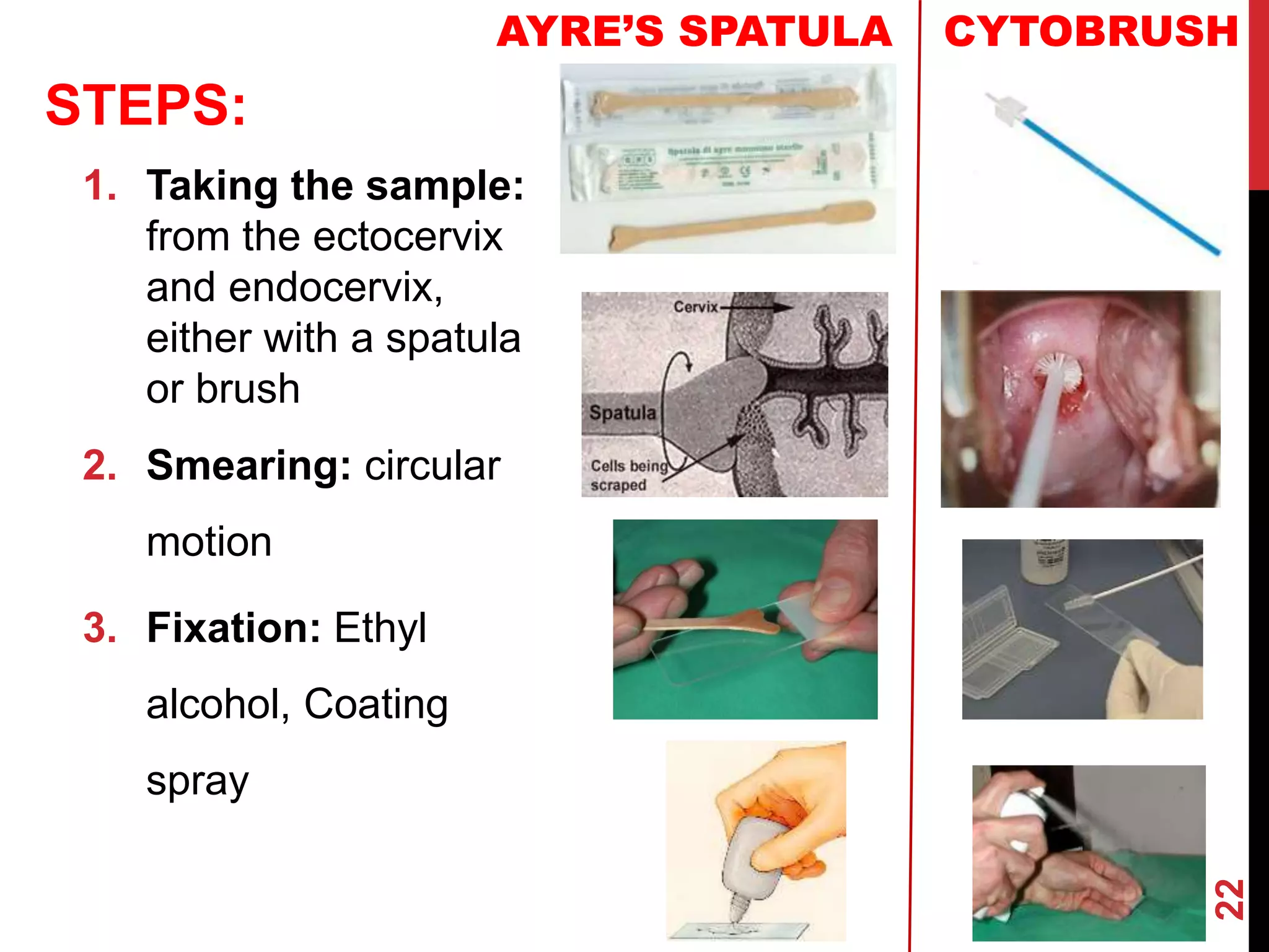 Preinvasive lesion of ca cervix(CIN) | PPTX