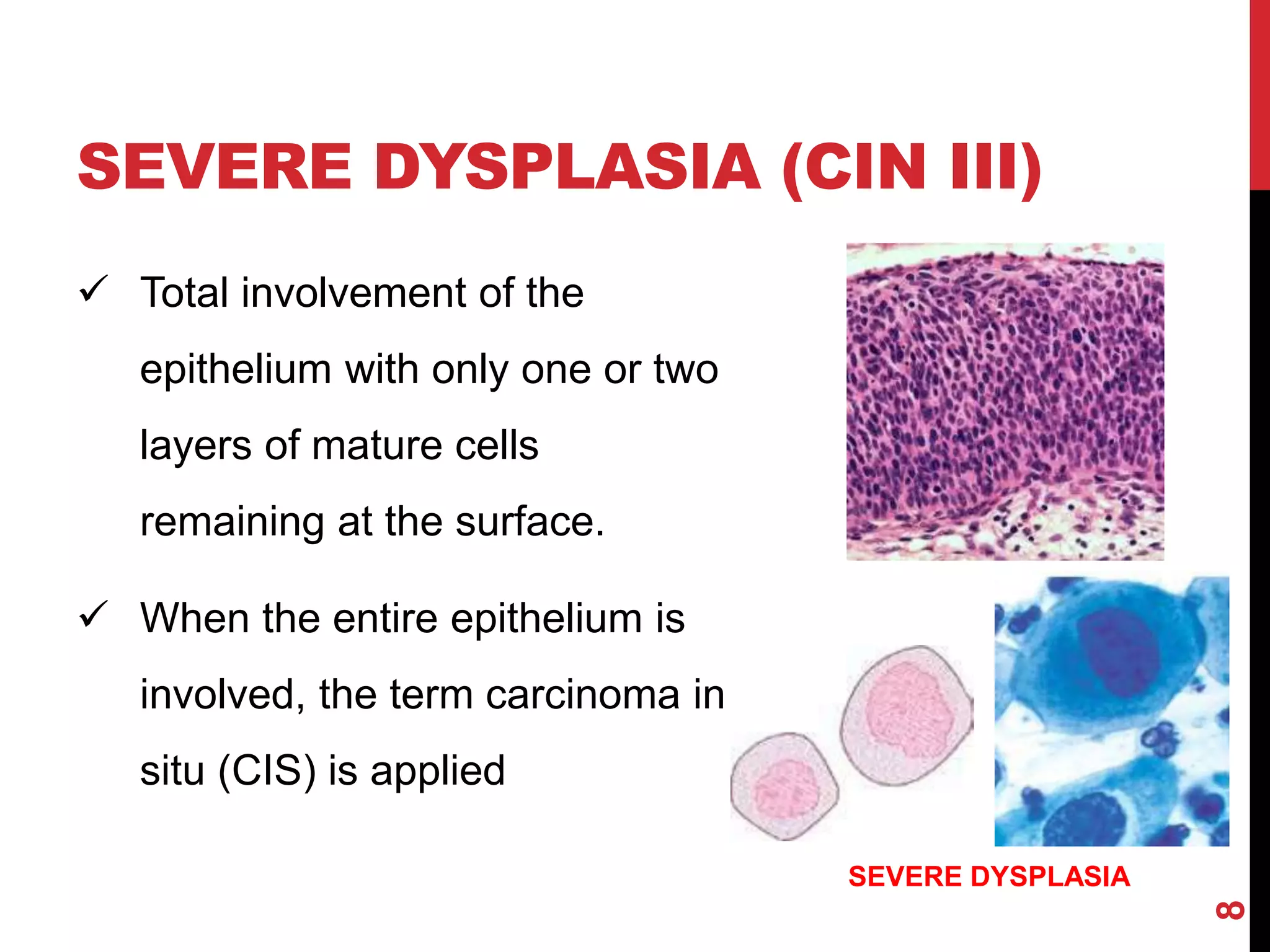 Preinvasive lesion of ca cervix(CIN) | PPTX