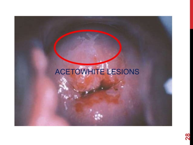 Preinvasive Lesion Of Ca Cervixcin Ppt