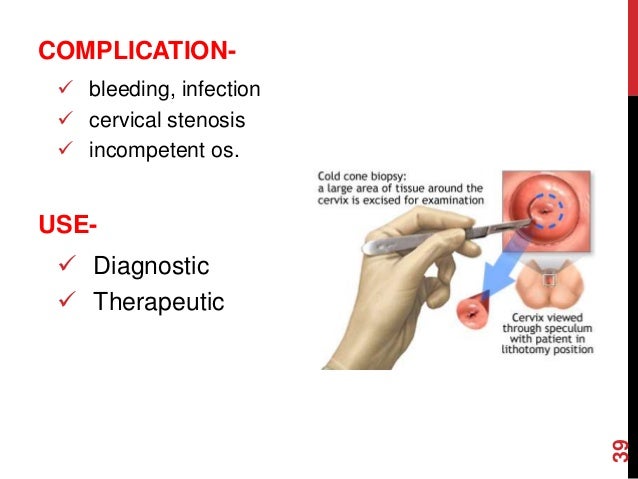 Preinvasive lesion of ca cervix(CIN)