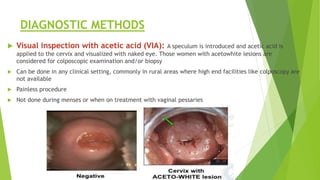 Cervical Cancer | PPTX