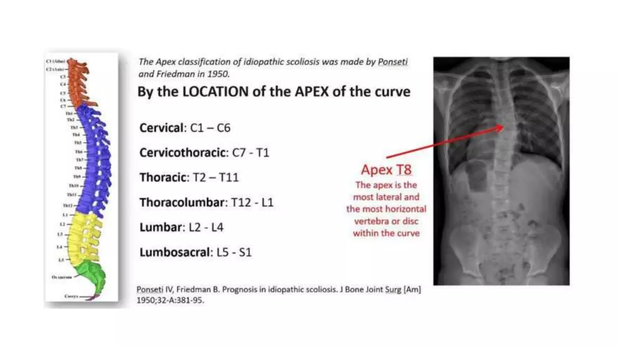 Pre lenke scoliosis classification.pptx