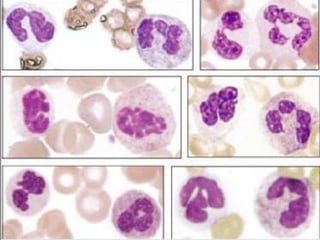 Pre leukemia MDS | PPTX