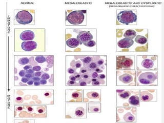 Pre leukemia MDS | PPTX