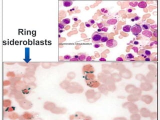 Pre leukemia MDS | PPTX