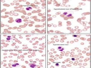 Pre leukemia MDS | PPTX