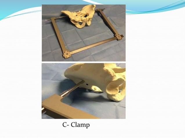 Preliminary management of pelvic injury | PPT