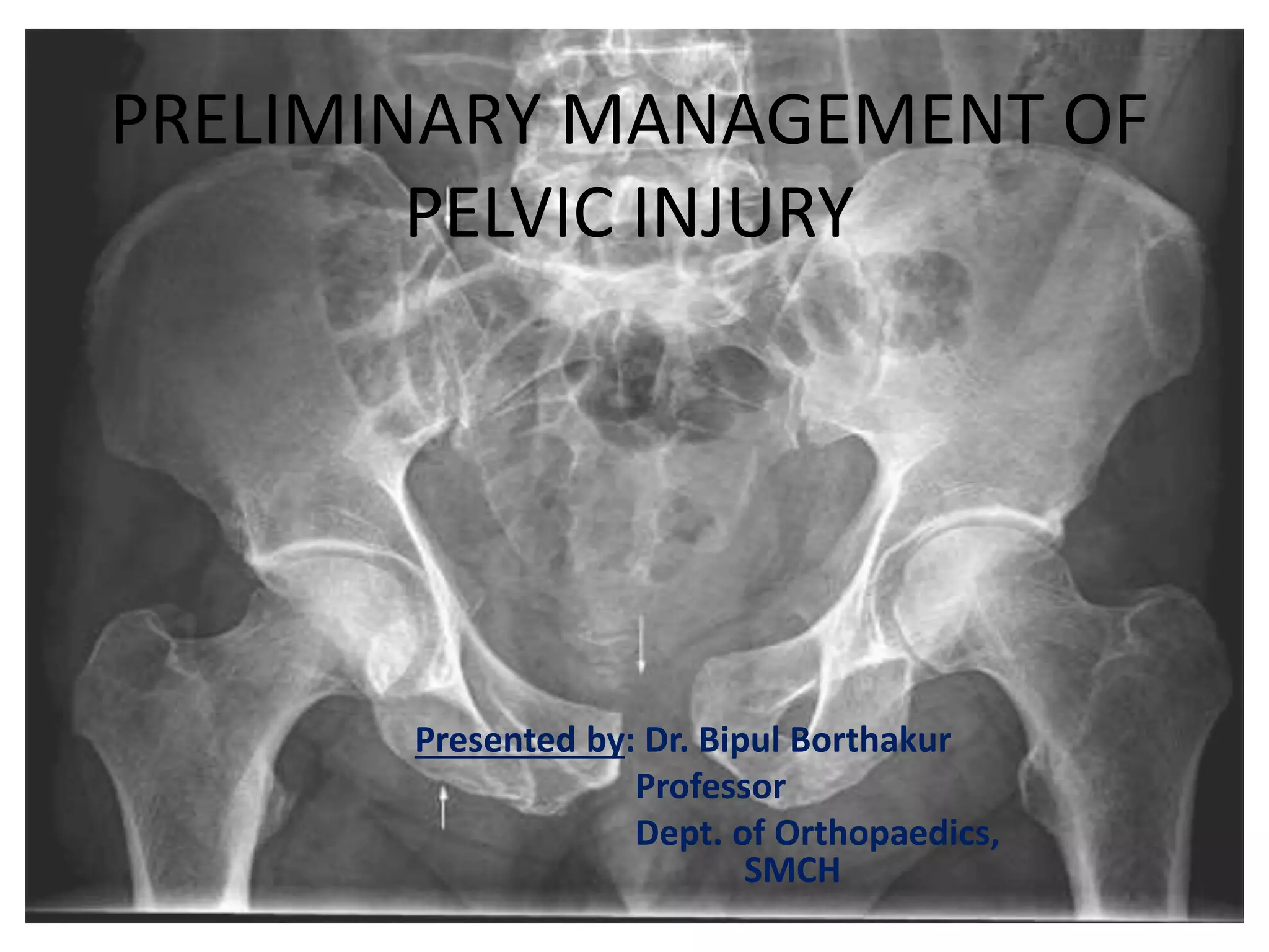 Preliminary management of pelvic injury | PPTX