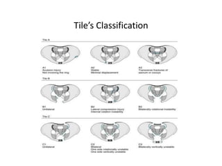 Preliminary management of pelvic injury | PPTX | First Aid | Injuries