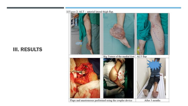 Preliminary results using coupler in microsurgery | PDF | First Aid ...