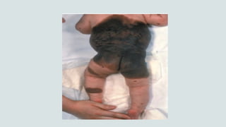 PREMALIGNANT Lesions of SKIN - (4).pptx