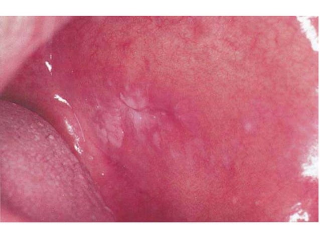 Premalignant-lesion-&-Condition-20207231010110.ppt